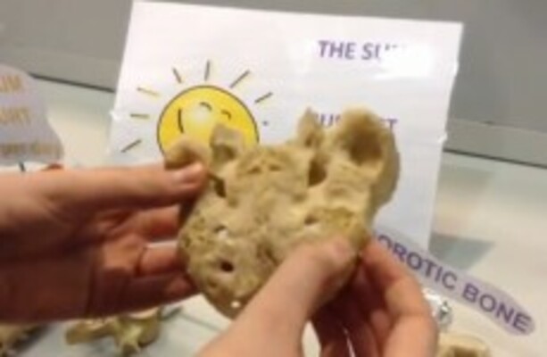 This is what your bones look like if you have osteoporosis