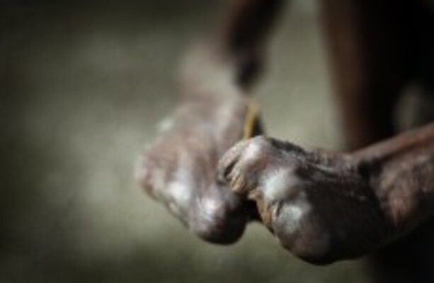 Leprosy victims crippled and suffering because of fear and prejudice