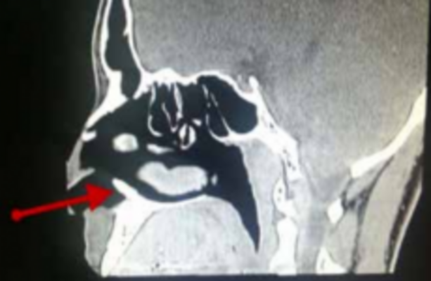 Man goes to doctor with chronic nosebleeds, discovers rogue tooth in nose