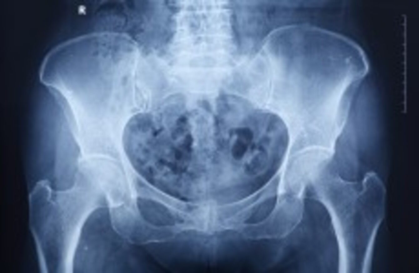 At least 257 symphysiotomy survivors apply for redress scheme