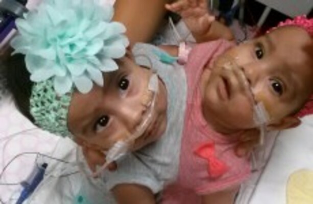 Conjoined twins successfully separated after 24 hour surgery