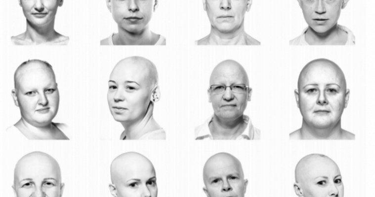 These women with alopecia were captured beautifully by a Dublin ...
