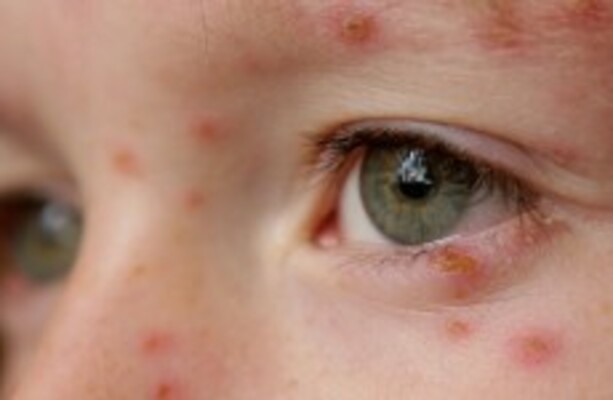 Warnings over 'chickenpox lollipops' · TheJournal.ie