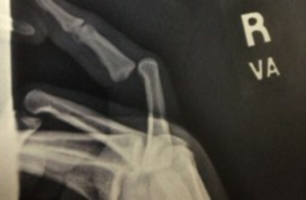 NFL player tweets X-ray of his broken finger 'to prove he didn't commit ...