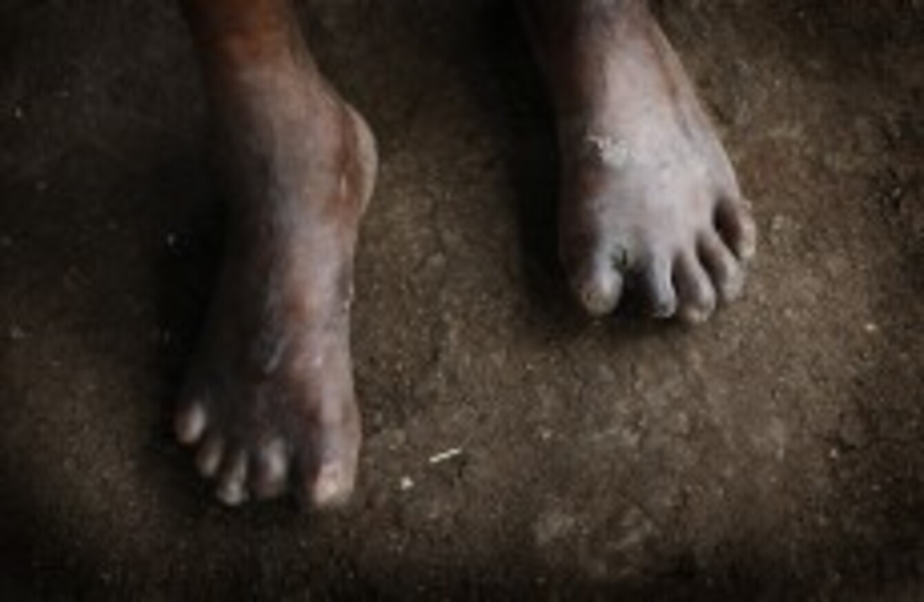 Ireland records first known case of leprosy in decades · TheJournal.ie