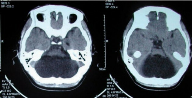 A woman was missing part of her brain for 24 years - and nobody noticed