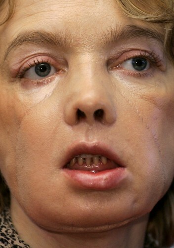 Heart in a bag… and 7 other medical firsts · The Daily Edge