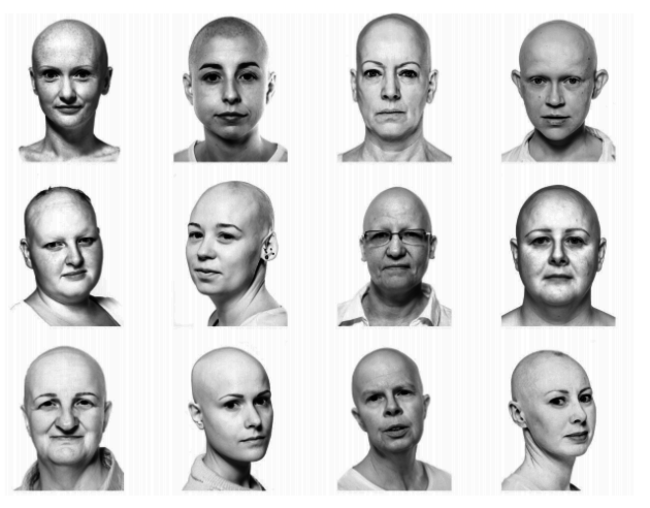 These women with alopecia were captured beautifully by a Dublin ...