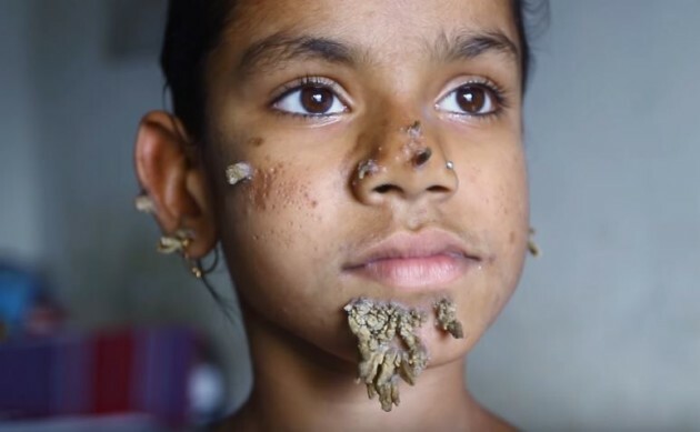 First Female To Suffer From Tree Man Syndrome Undergoes Successful