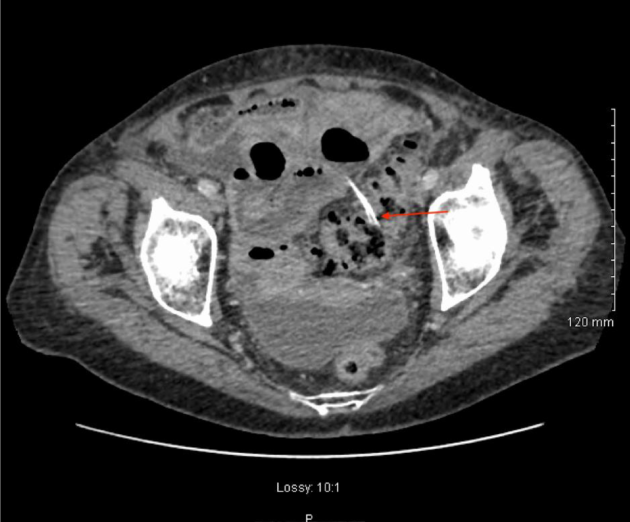 Doctors discover Dublin woman (81) suffering stomach pains had ...