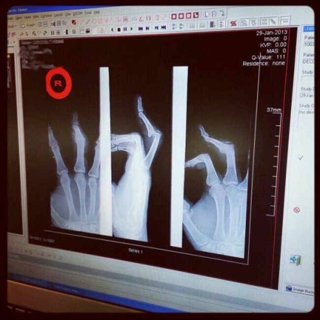NFL player tweets X-ray of what his mangled finger looked like during ...